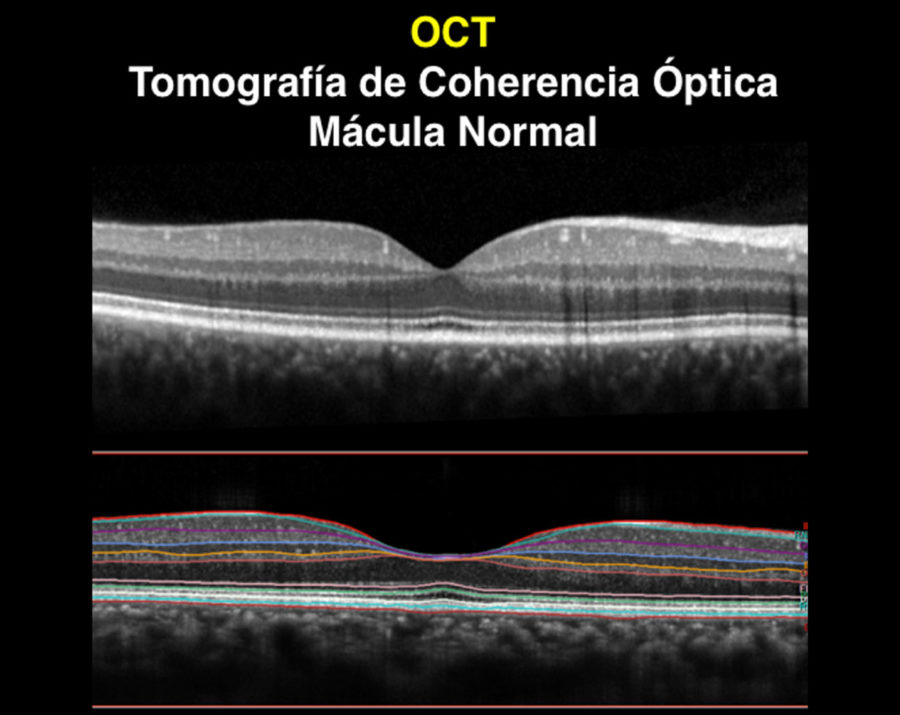Tomografía de Coherencia Óptica – OCT | Retina y Mácula Consultores